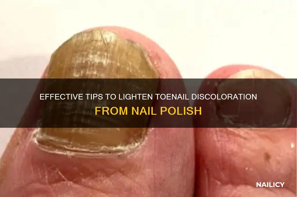 Effective Tips To Lighten Toenail Discoloration From Nail Polish | Nailicy