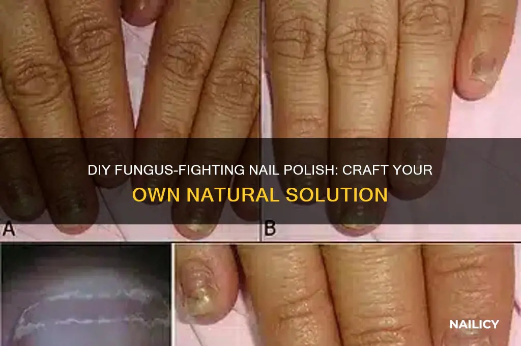 Diy Fungus-Fighting Nail Polish: Craft Your Own Natural Solution | Nailicy
