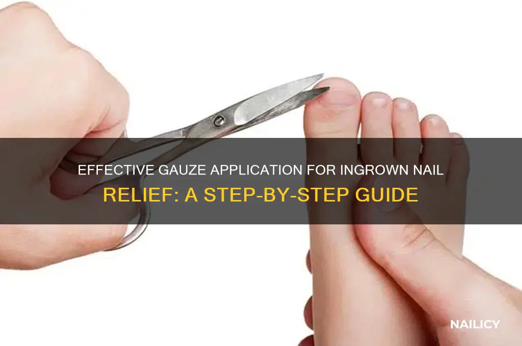 Effective Gauze Application For Ingrown Nail Relief: A Step-By-Step ...