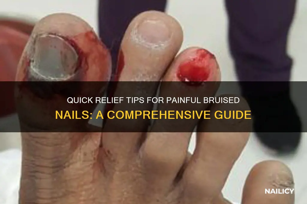 Quick Relief Tips For Painful Bruised Nails: A Comprehensive Guide ...