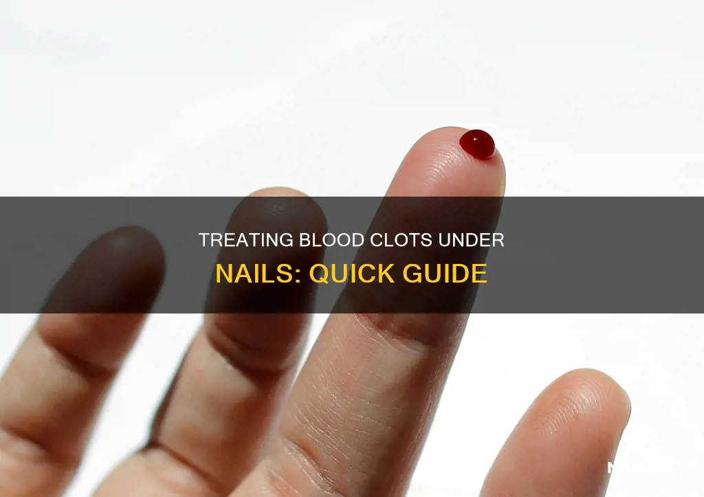 Treating Blood Clots Under Nails: Quick Guide | Nailicy