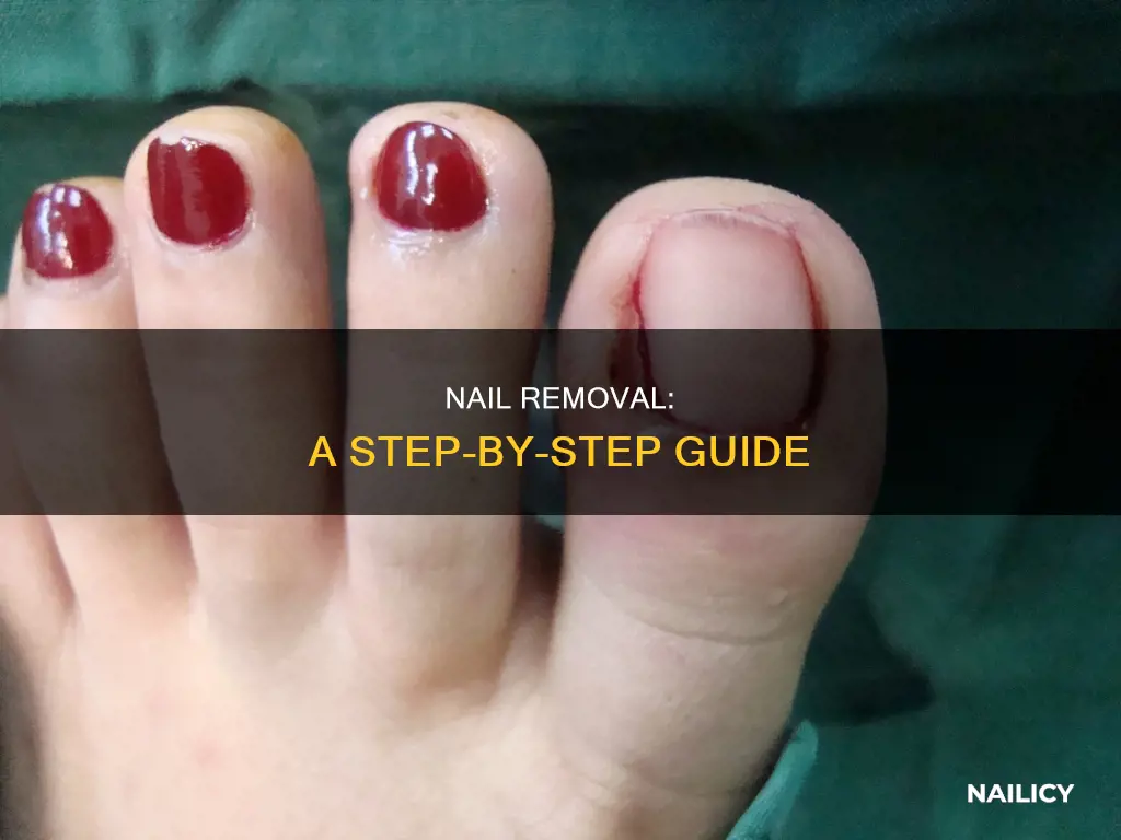 Nail Removal: A Step-By-Step Guide | Nailicy