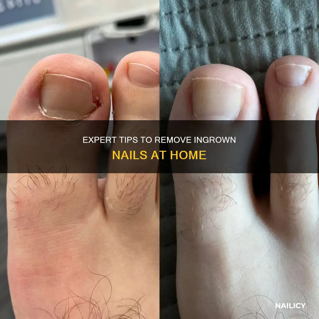 Expert Tips To Remove Ingrown Nails At Home | Nailicy