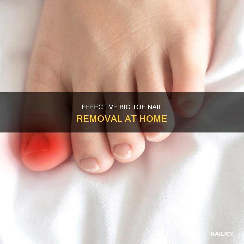 Effective Big Toe Nail Removal At Home | Nailicy