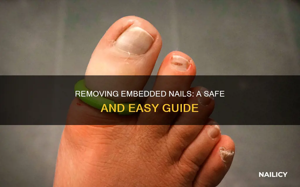 Removing Embedded Nails: A Safe And Easy Guide | Nailicy