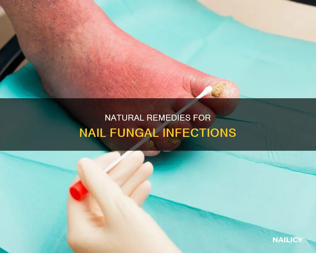 Natural Remedies For Nail Fungal Infections | Nailicy