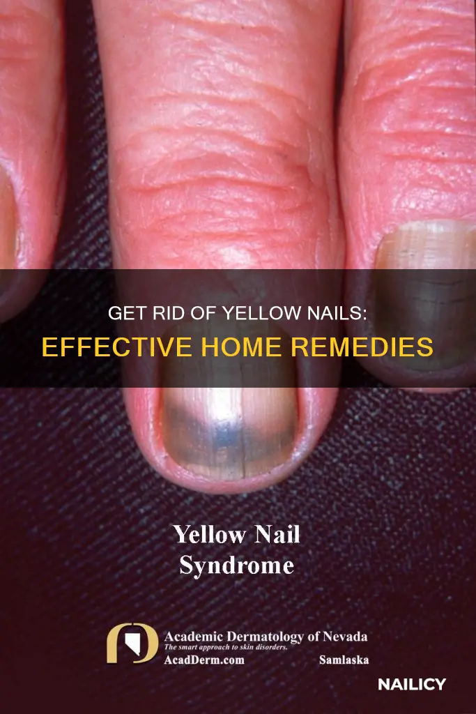 Get Rid Of Yellow Nails: Effective Home Remedies | Nailicy