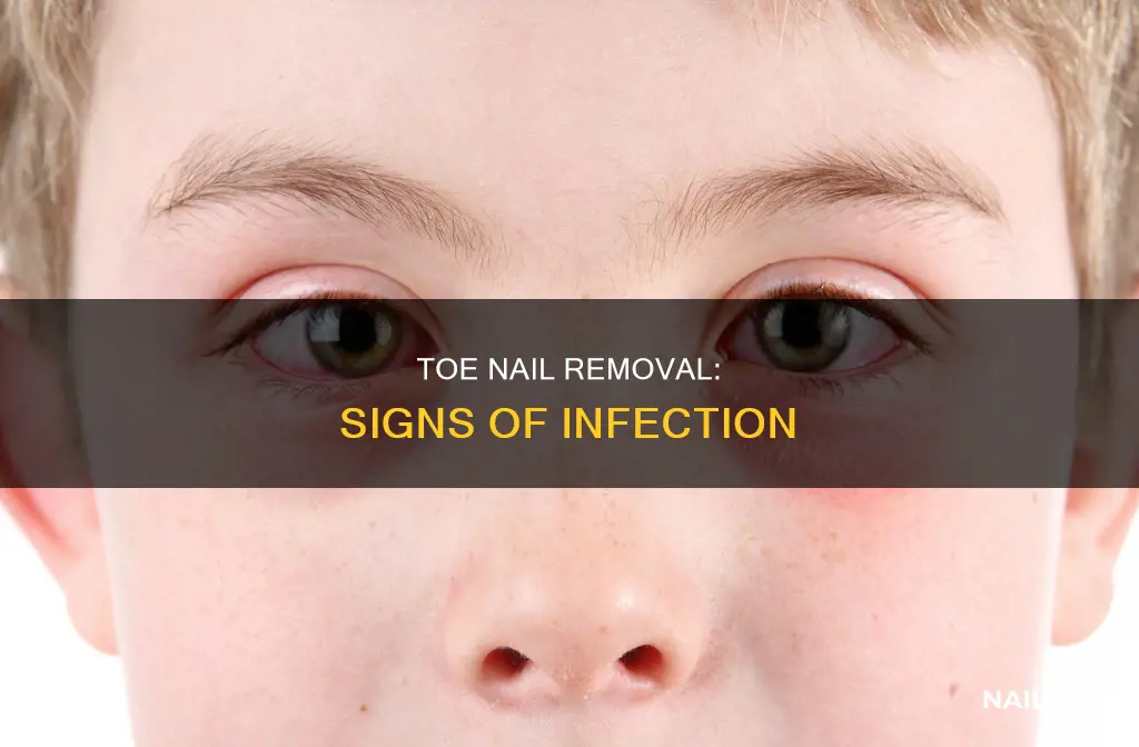Toe Nail Removal: Signs Of Infection | Nailicy