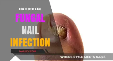 Effective Remedies For Treating Severe Fungal Nail Infections At Home ...