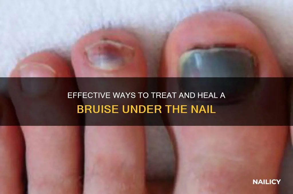Effective Ways To Treat And Heal A Bruise Under The Nail | Nailicy