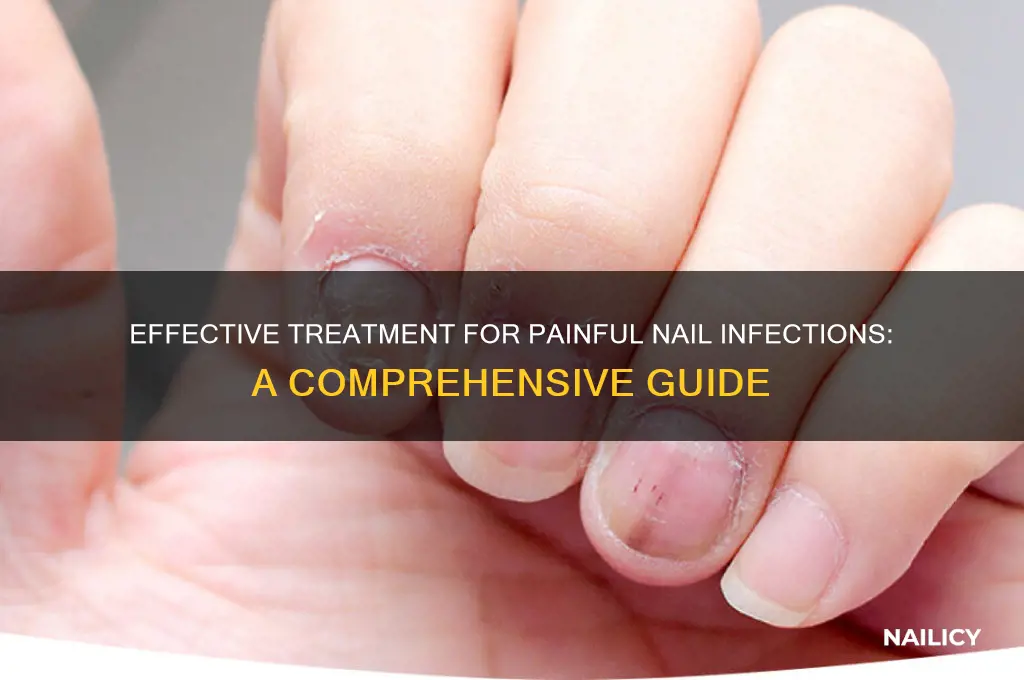 Effective Treatment For Painful Nail Infections: A Comprehensive Guide ...