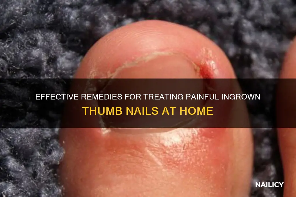 Effective Remedies For Treating Painful Ingrown Thumb Nails At Home ...