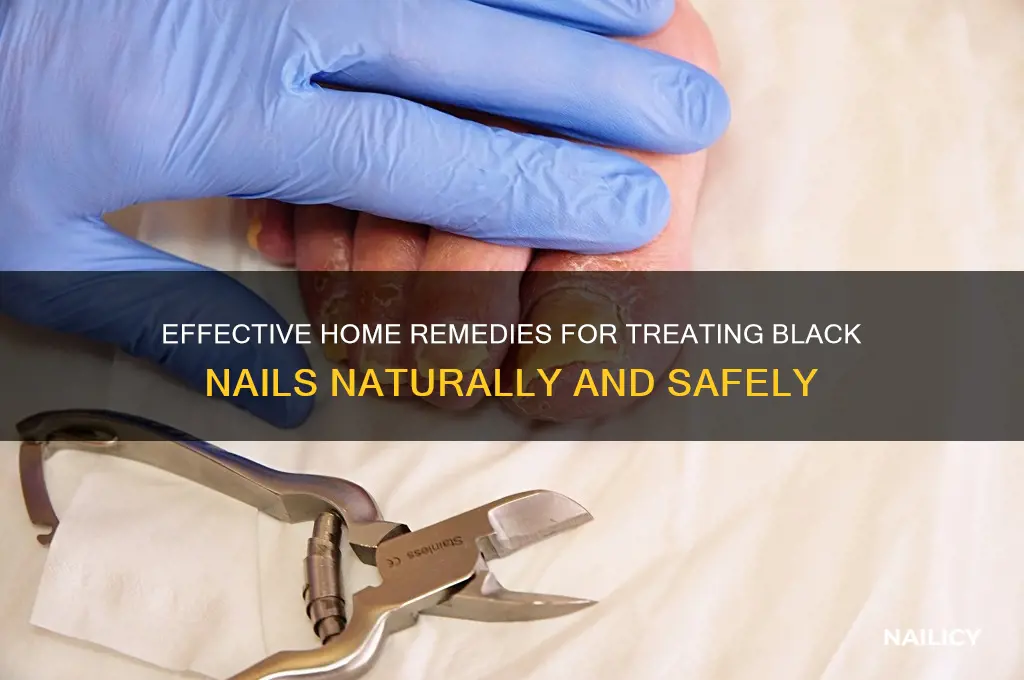 Effective Home Remedies For Treating Black Nails Naturally And Safely ...
