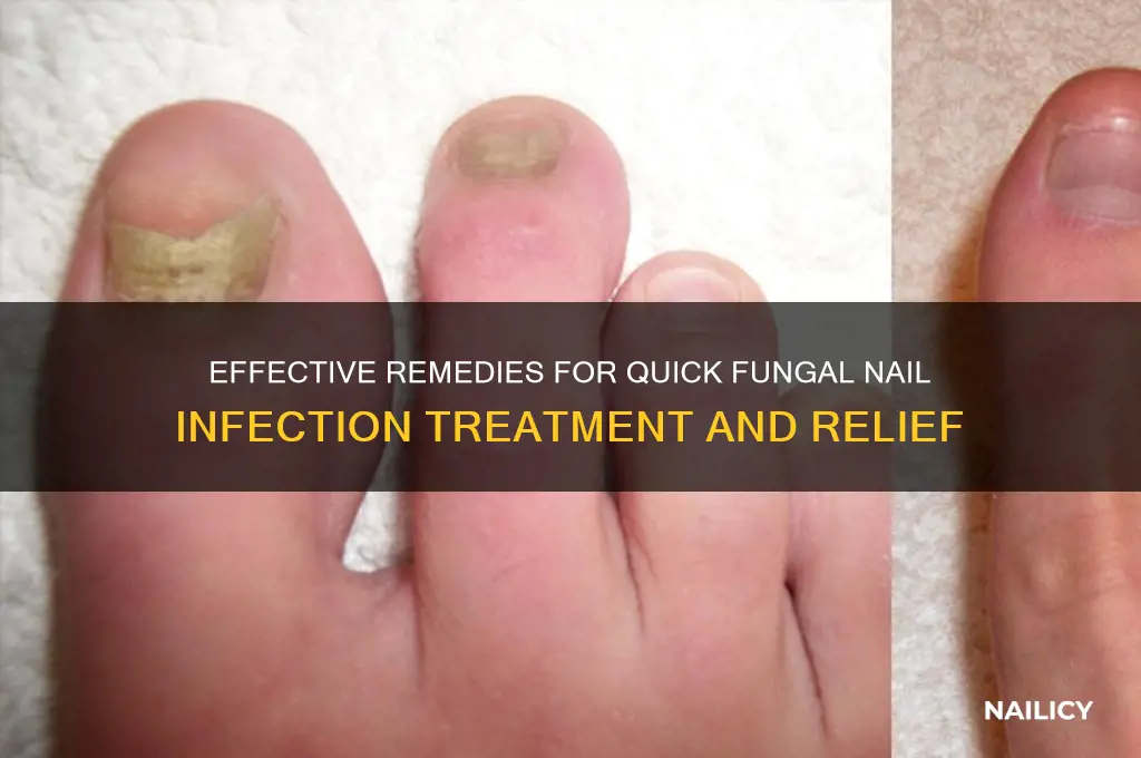 Effective Remedies For Quick Fungal Nail Infection Treatment And Relief ...