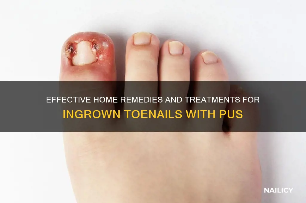 Effective Home Remedies And Treatments For Ingrown Toenails With Pus ...