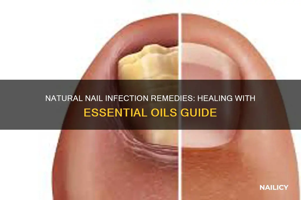 Natural Nail Infection Remedies: Healing With Essential Oils Guide ...