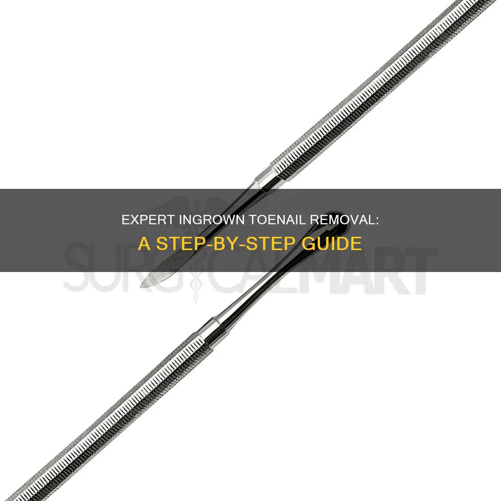 Expert Ingrown Toenail Removal: A Step-By-Step Guide | Nailicy