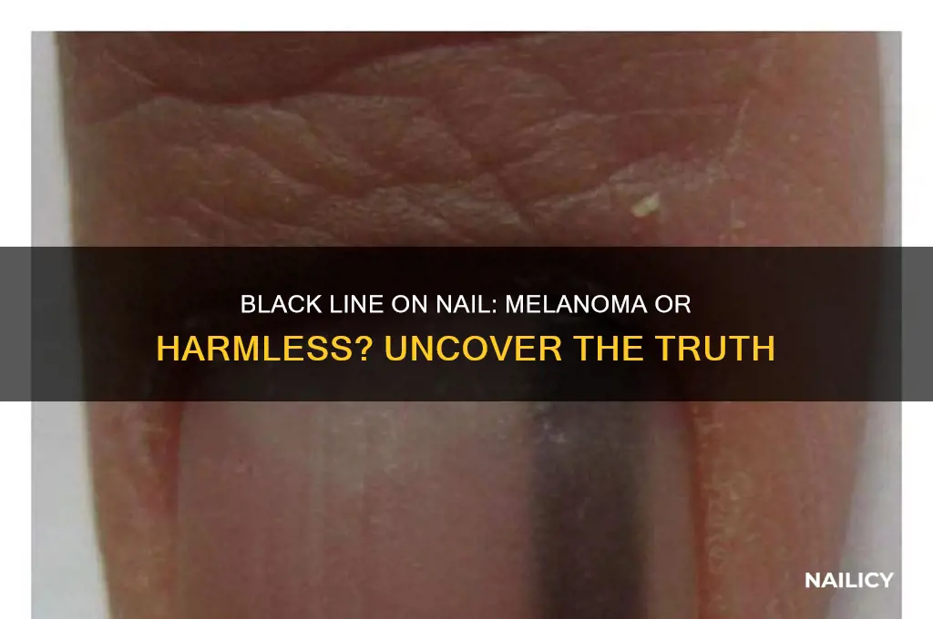 Black Line On Nail: Melanoma Or Harmless? Uncover The Truth | Nailicy