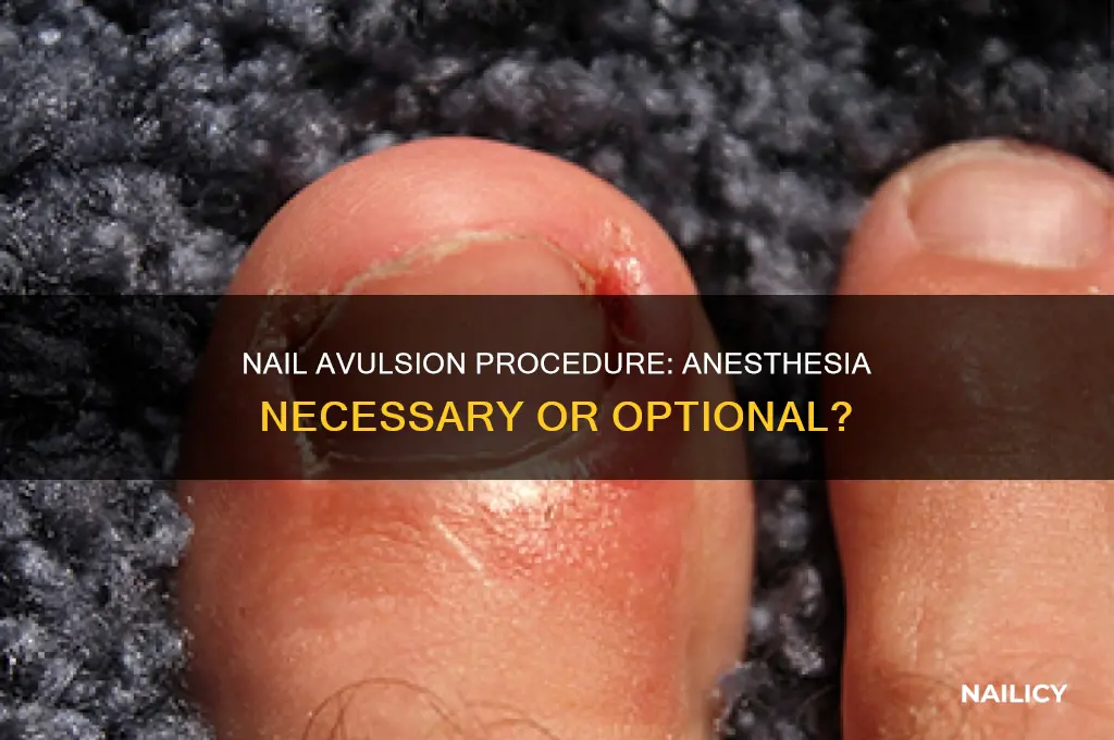Nail Avulsion Procedure: Anesthesia Necessary Or Optional? | Nailicy