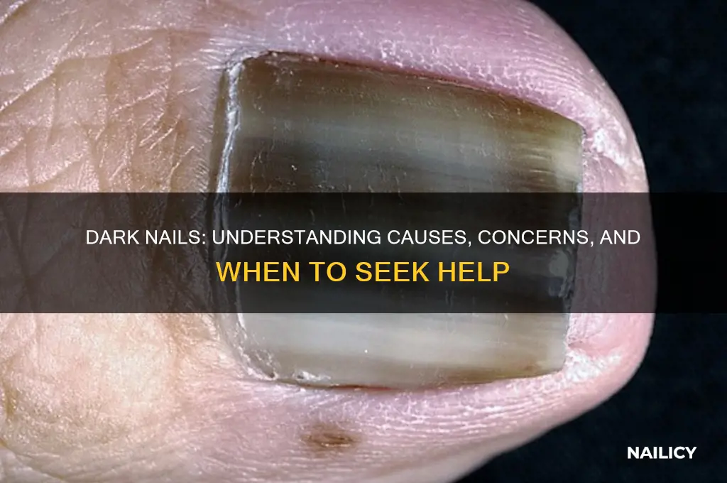 Dark Nails: Understanding Causes, Concerns, And When To Seek Help | Nailicy