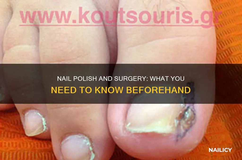 Nail Polish And Surgery: What You Need To Know Beforehand | Nailicy
