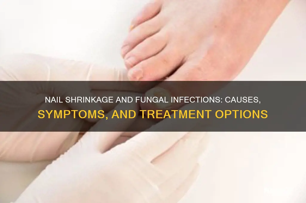 Nail Shrinkage And Fungal Infections: Causes, Symptoms, And Treatment ...