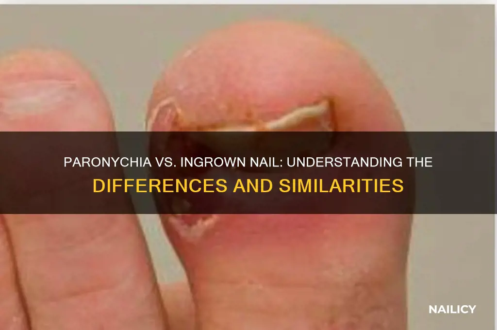 Paronychia Vs. Ingrown Nail: Understanding The Differences And ...