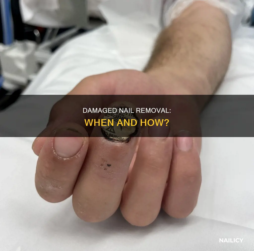Damaged Nail Removal: When And How? | Nailicy