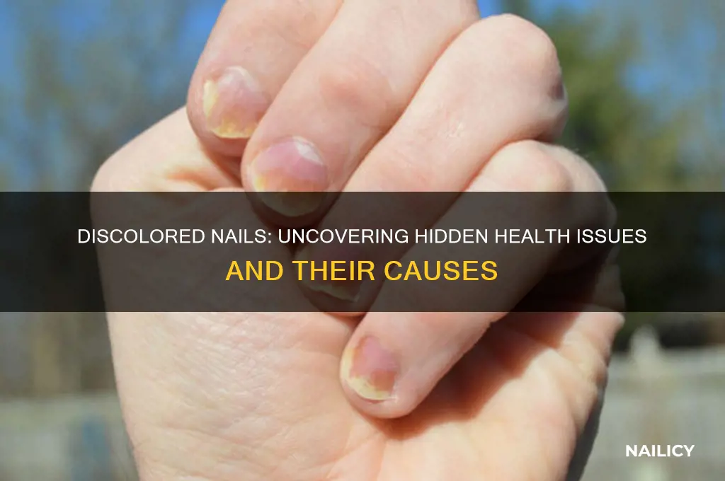 Discolored Nails: Uncovering Hidden Health Issues And Their Causes ...