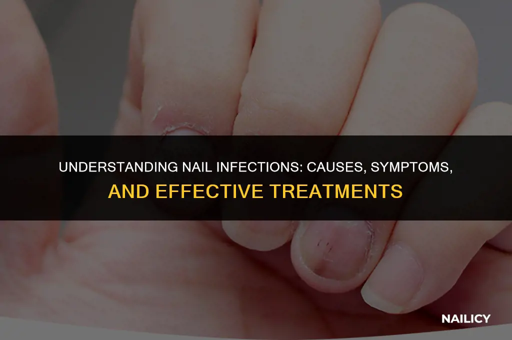 Understanding Nail Infections: Causes, Symptoms, And Effective ...