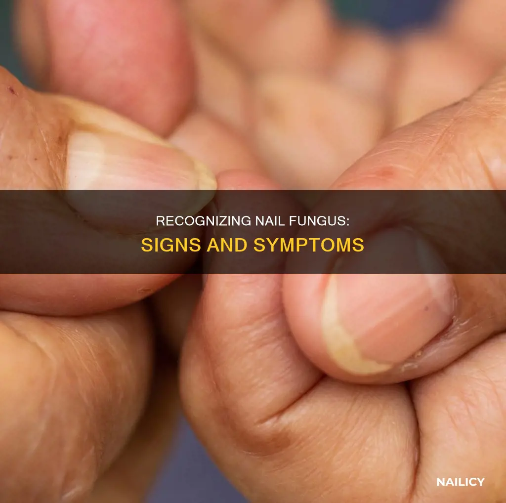 Recognizing Nail Fungus: Signs And Symptoms | Nailicy