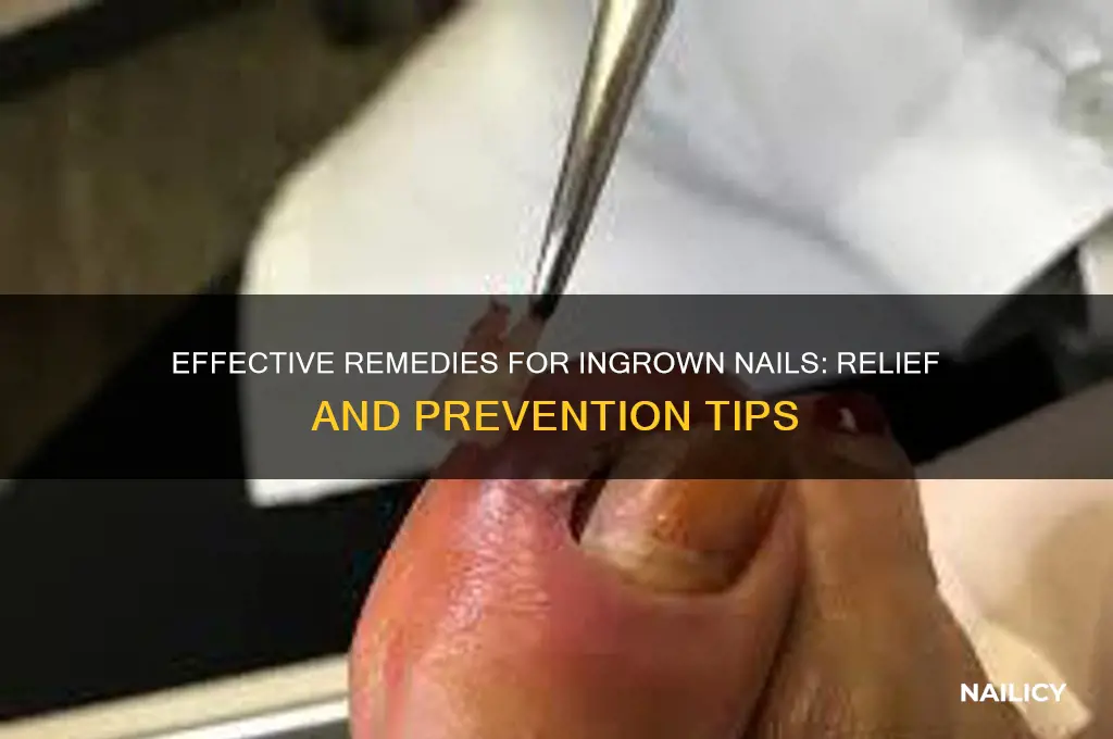 Effective Remedies For Ingrown Nails: Relief And Prevention Tips | Nailicy
