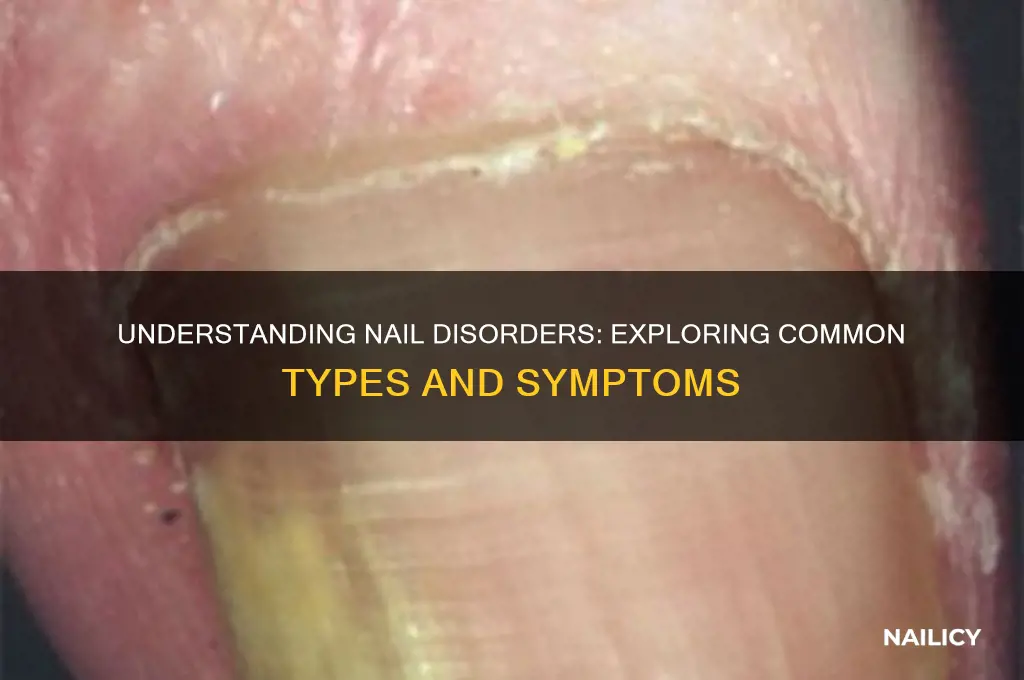 Understanding Nail Disorders: Exploring Common Types And Symptoms | Nailicy