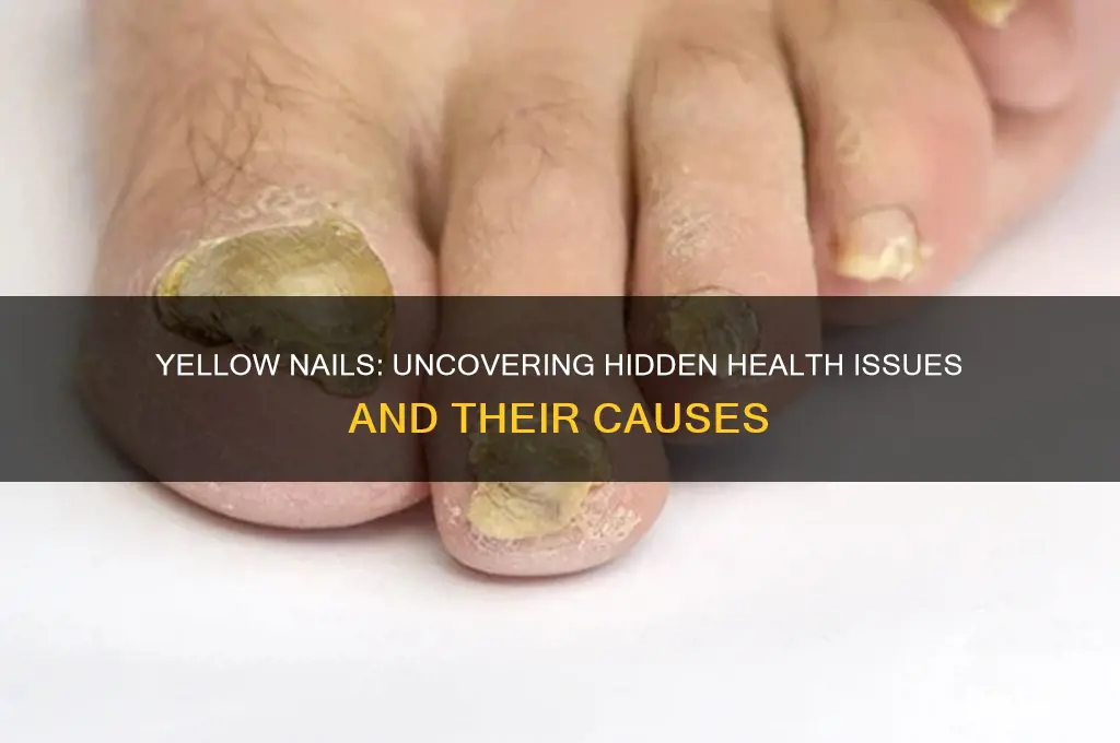 Yellow Nails: Uncovering Hidden Health Issues And Their Causes | Nailicy