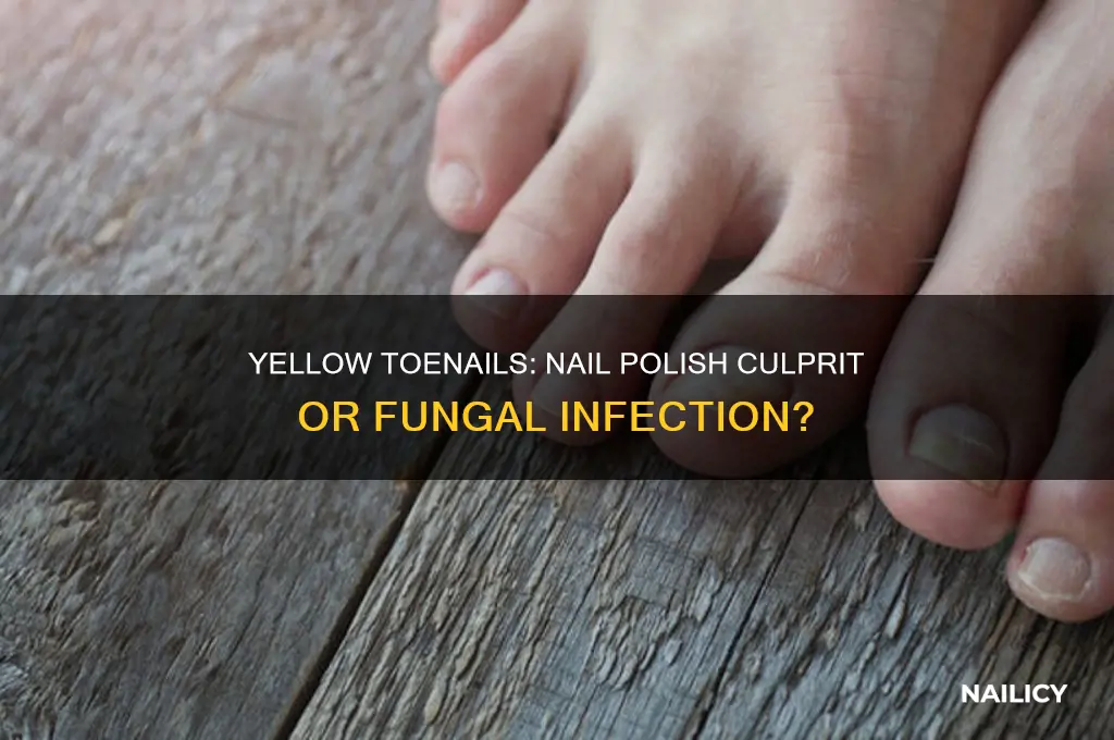 Yellow Toenails: Nail Polish Culprit Or Fungal Infection? | Nailicy