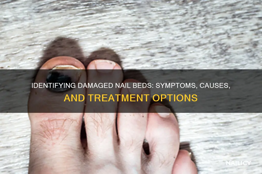 Identifying Damaged Nail Beds: Symptoms, Causes, And Treatment Options ...