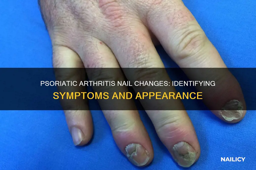 Psoriatic Arthritis Nail Changes: Identifying Symptoms And Appearance ...