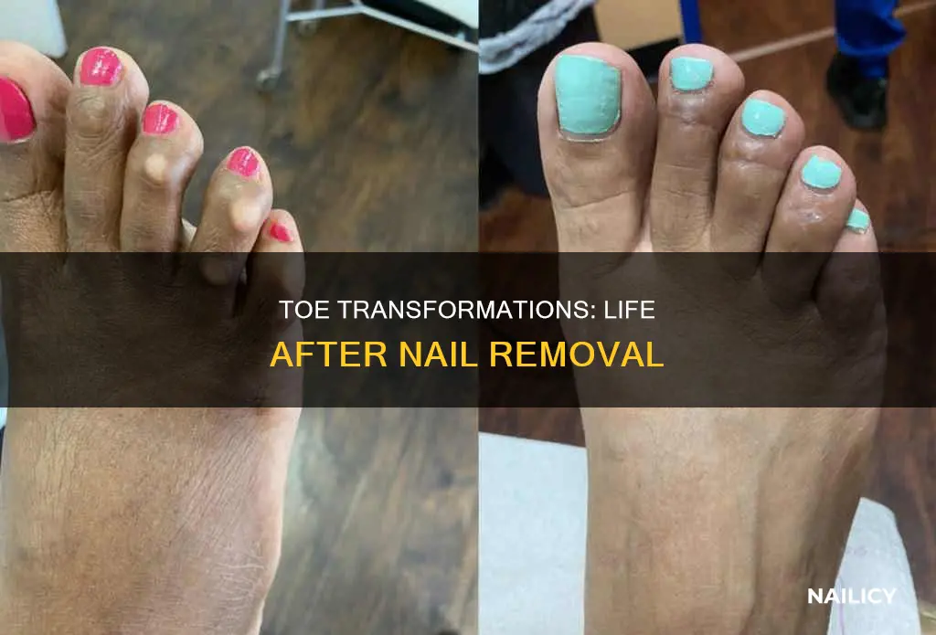 Toe Transformations: Life After Nail Removal | Nailicy