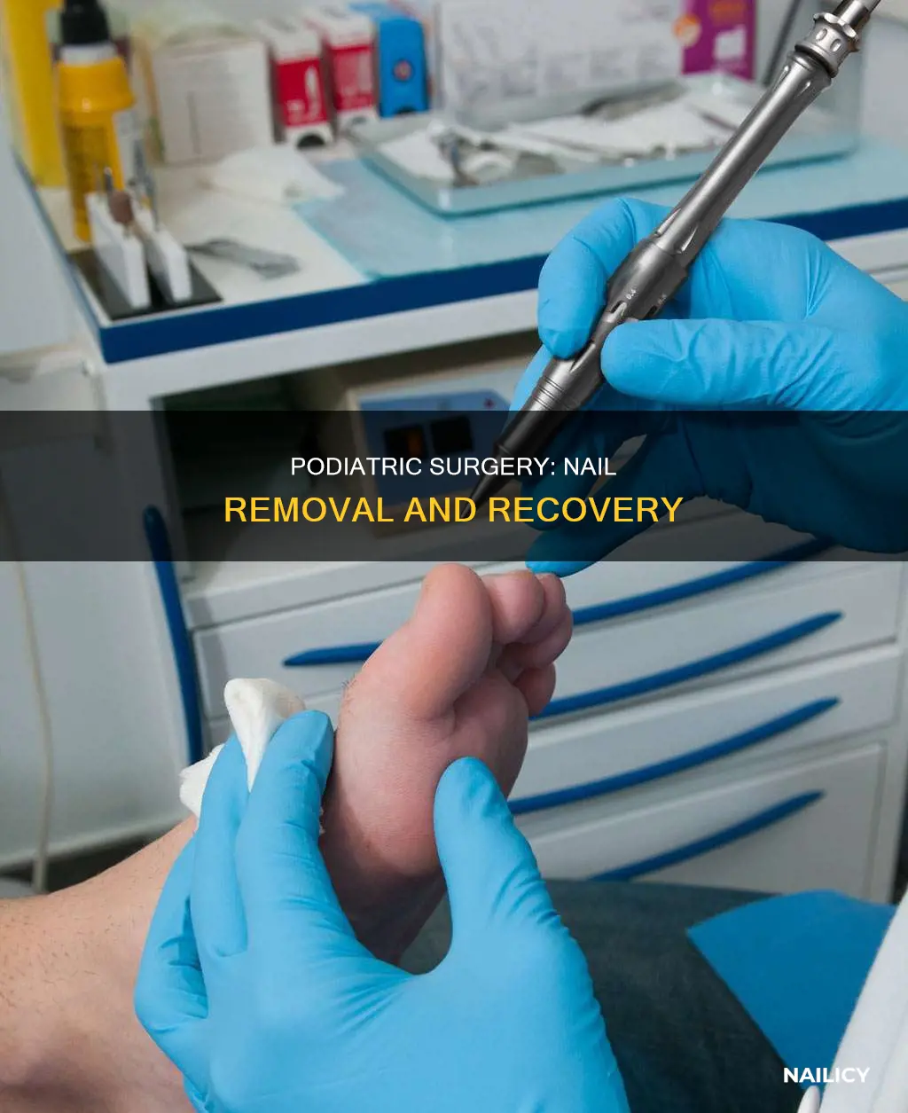 Podiatric Surgery: Nail Removal And Recovery | Nailicy