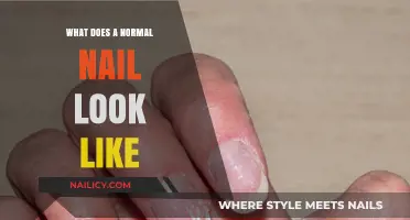 Spoon Nail Appearance: Identifying Koilonychia Symptoms And Causes ...