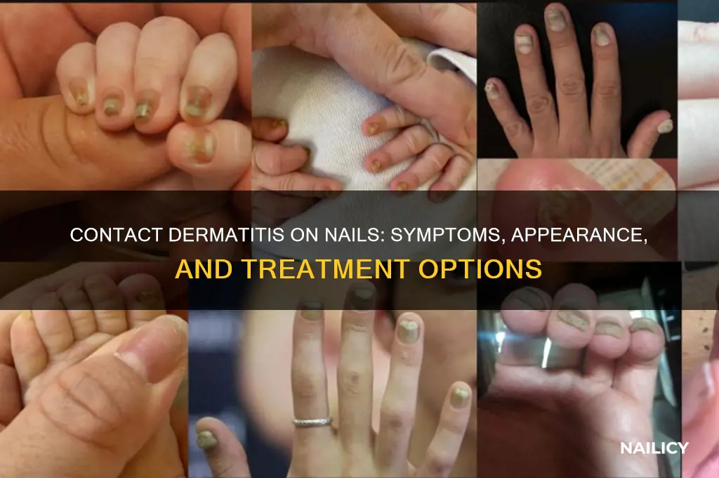 Contact Dermatitis On Nails: Symptoms, Appearance, And Treatment ...