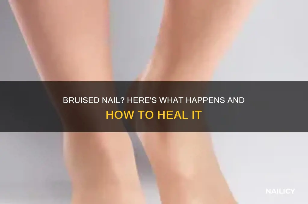 Bruised Nail? Here's What Happens And How To Heal It | Nailicy