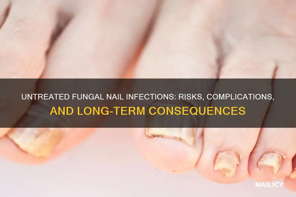 Untreated Fungal Nail Infections: Risks, Complications, And Long-Term ...