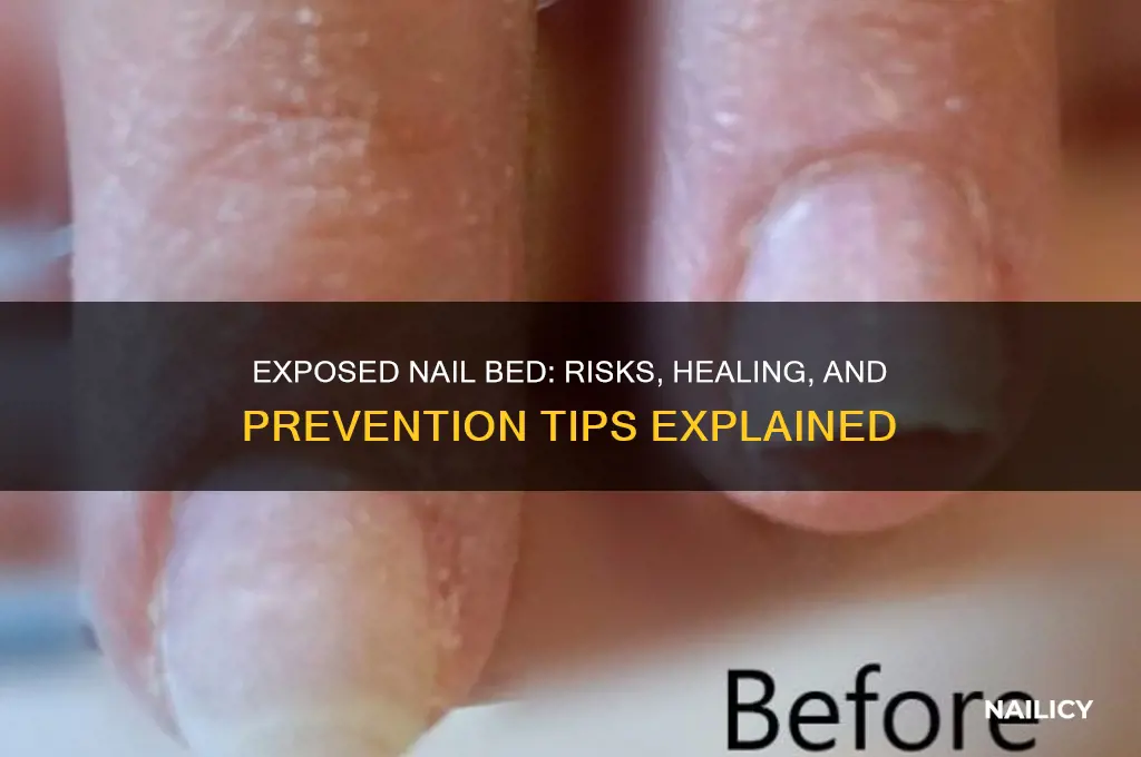 Exposed Nail Bed: Risks, Healing, And Prevention Tips Explained | Nailicy