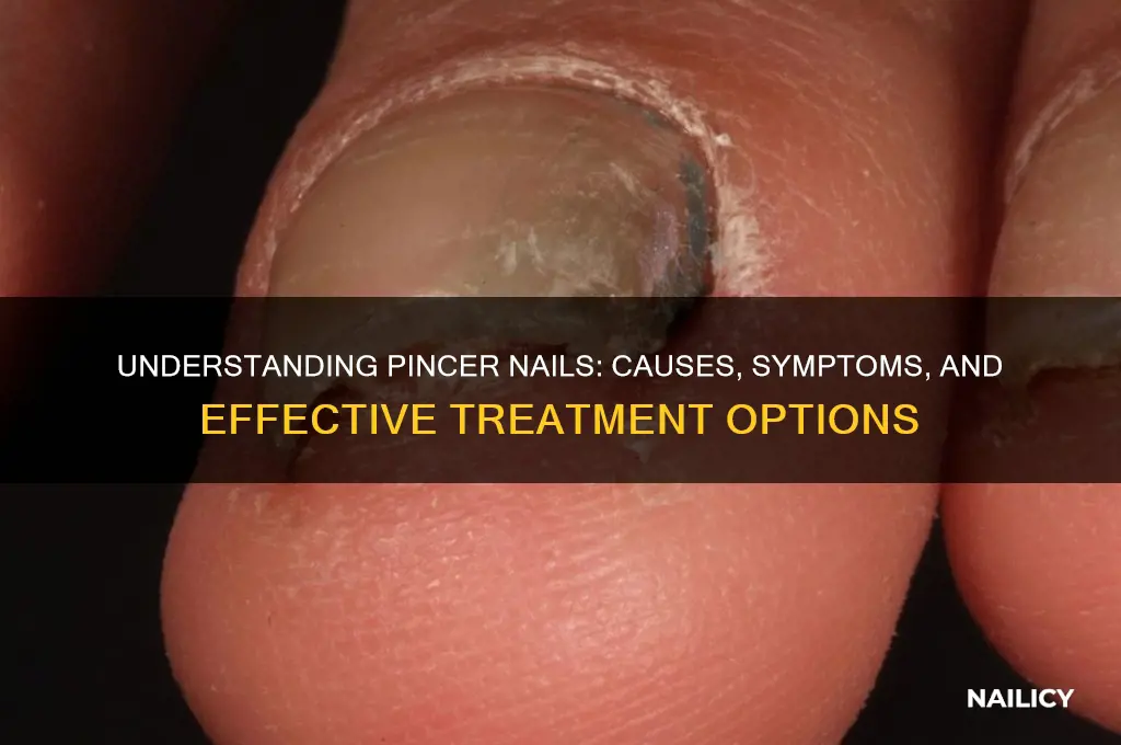 Understanding Pincer Nails: Causes, Symptoms, And Effective Treatment ...