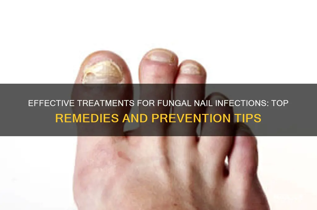 Effective Treatments For Fungal Nail Infections: Top Remedies And ...