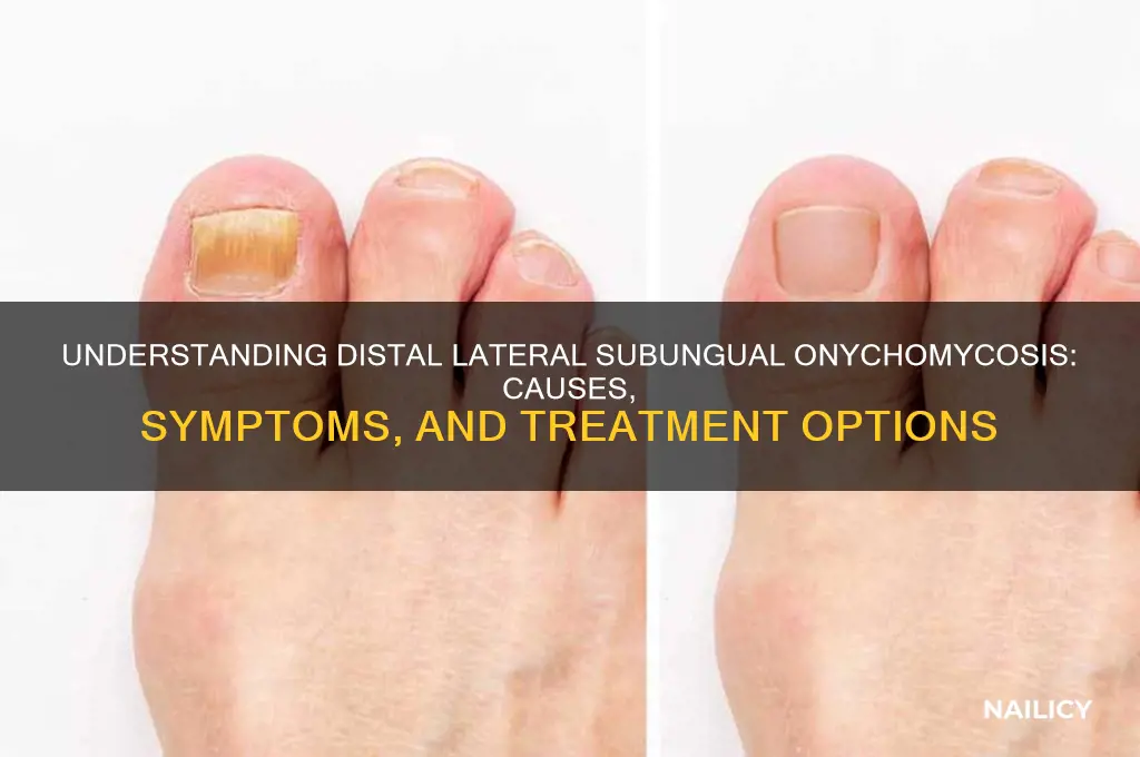 Understanding Distal Lateral Subungual Onychomycosis: Causes, Symptoms ...
