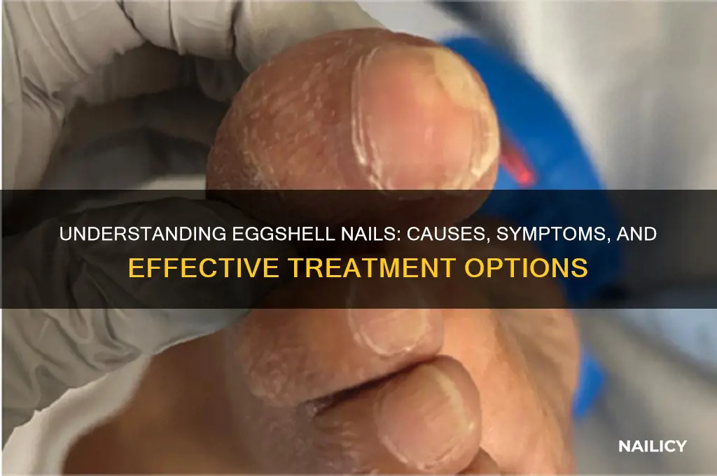 Understanding Eggshell Nails: Causes, Symptoms, And Effective Treatment ...