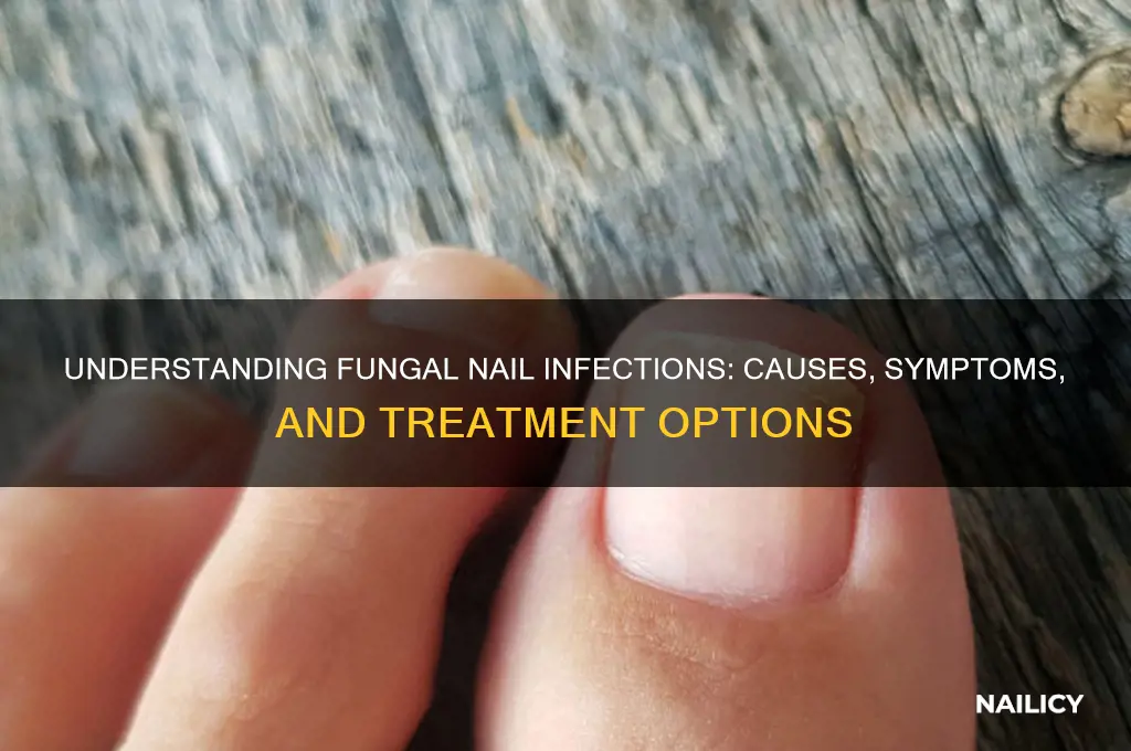 Understanding Fungal Nail Infections: Causes, Symptoms, And Treatment ...