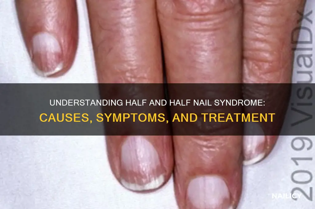 Understanding Half And Half Nail Syndrome: Causes, Symptoms, And ...